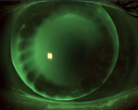 Patient Outcome: Post-PKP Corneal GP Lens Fit - Metro Optics