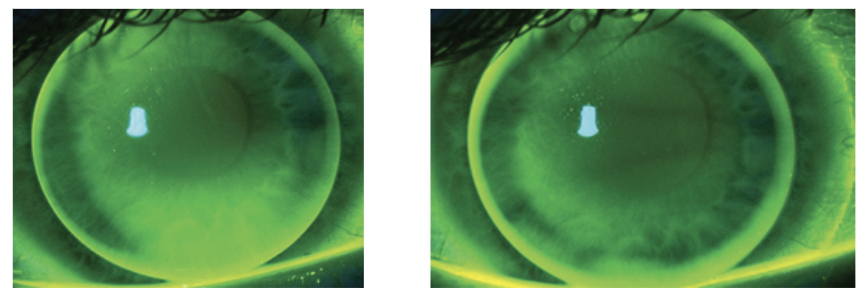 How to Empirically Fit Corneal GPs - Metro Optics